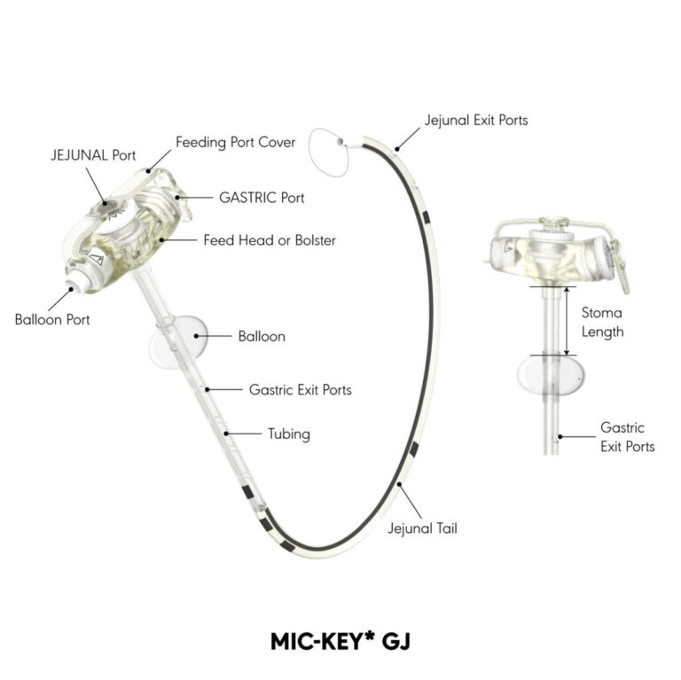 Gastro-Jejunal (GJ) Tubes - TubeFed