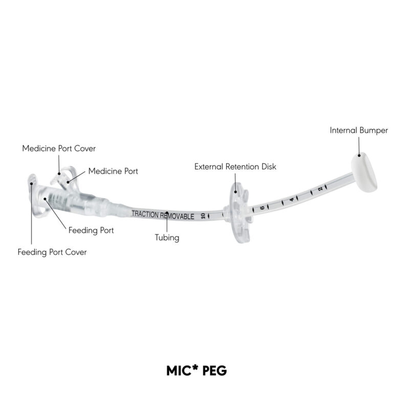 Percutaneous Endoscopic Gastrostomy (PEG) Tubes - TubeFed